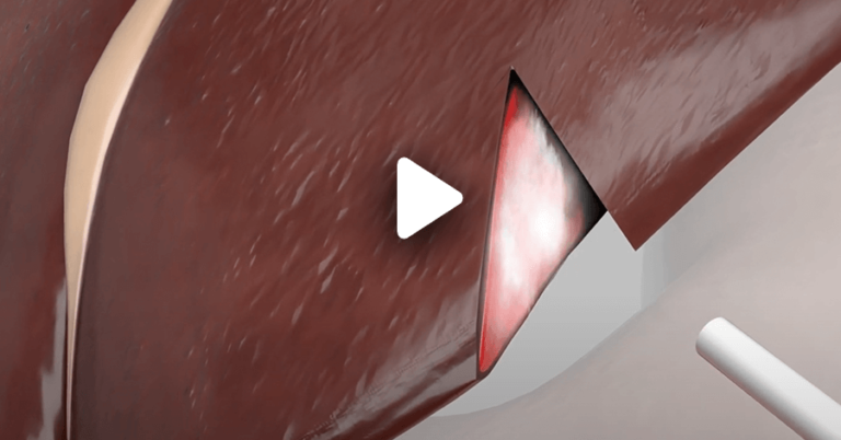 Hemoblast Surgical Videos